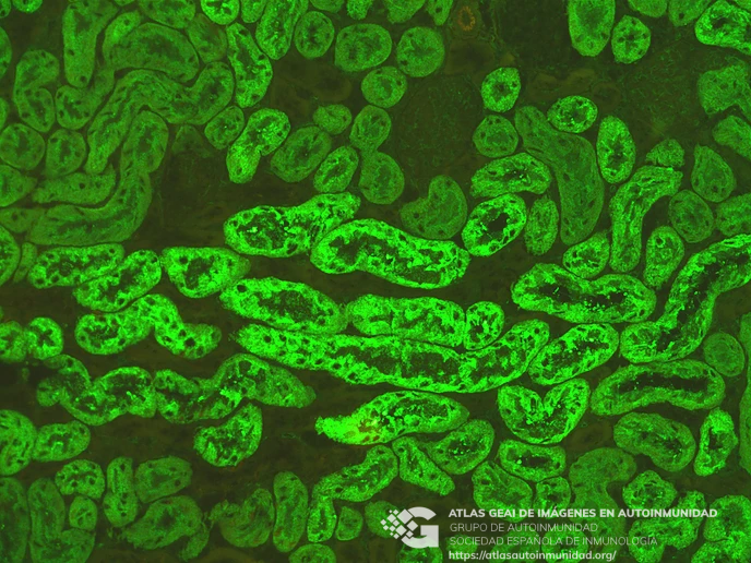 anti-lkm - Atlas GEAI de Imágenes en Autoinmunidad