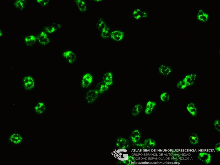 C-ANCA - Atlas GEAI de Imágenes en Autoinmunidad