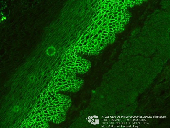 Sustancia intercelular epitelial - Atlas GEAI de Imágenes en Autoinmunidad