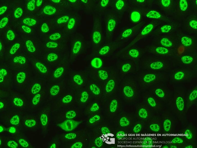 ANA Moteado grueso RNP+Sm - Atlas GEAI de Imágenes en Autoinmunidad