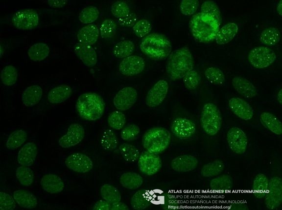 Anti-MJ/NXP2/p140 - Atlas GEAI de Imágenes en Autoinmunidad