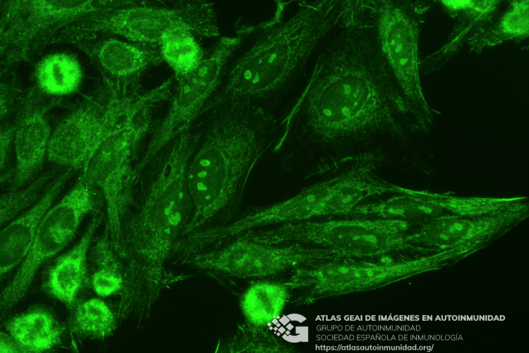 Nucleolar / Citoplasmático reticular (AMA) / Citoplasmático fibrilar ...