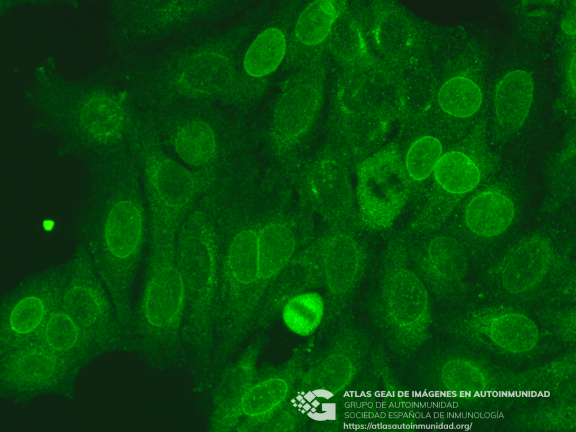 Membrana nuclear punteada y Citoplasmático granular fino - Atlas GEAI ...