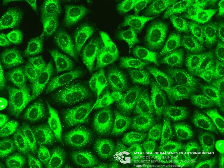 AC20 Citoplasmático moteado fino - Atlas GEAI de Imágenes en Autoinmunidad