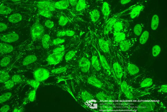 Patrón tipo NuMA y citoplasmático fibrilar lineal - Atlas GEAI de ...