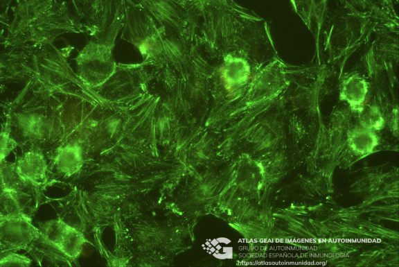 AC-15 Citoplasmático fibrilar linear - Atlas GEAI de Imágenes en ...