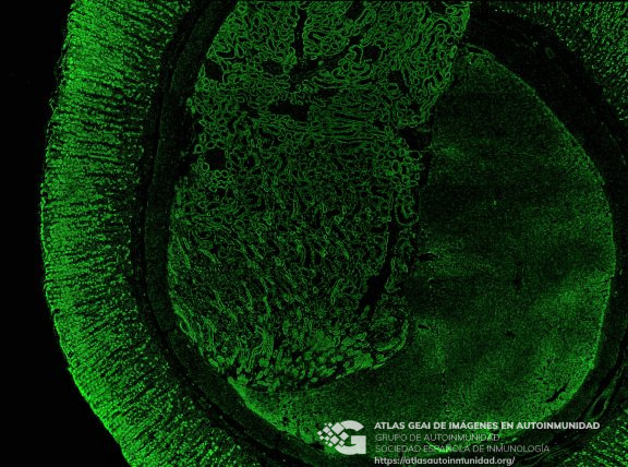 Ac. Anti-Mitocondriales AMA-M2 (IFI-TTR) - Atlas GEAI de Imágenes en ...