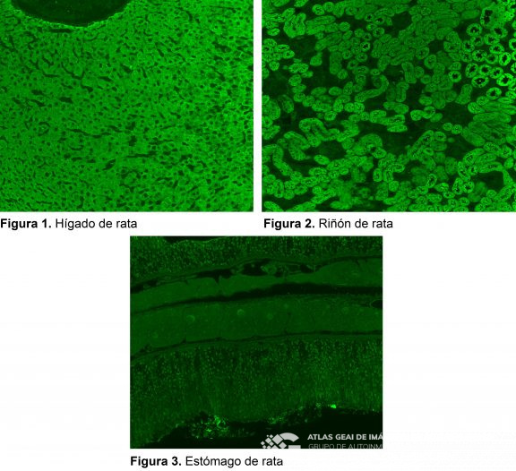 Anticuerpos anti-LKM - Atlas GEAI de Imágenes en Autoinmunidad